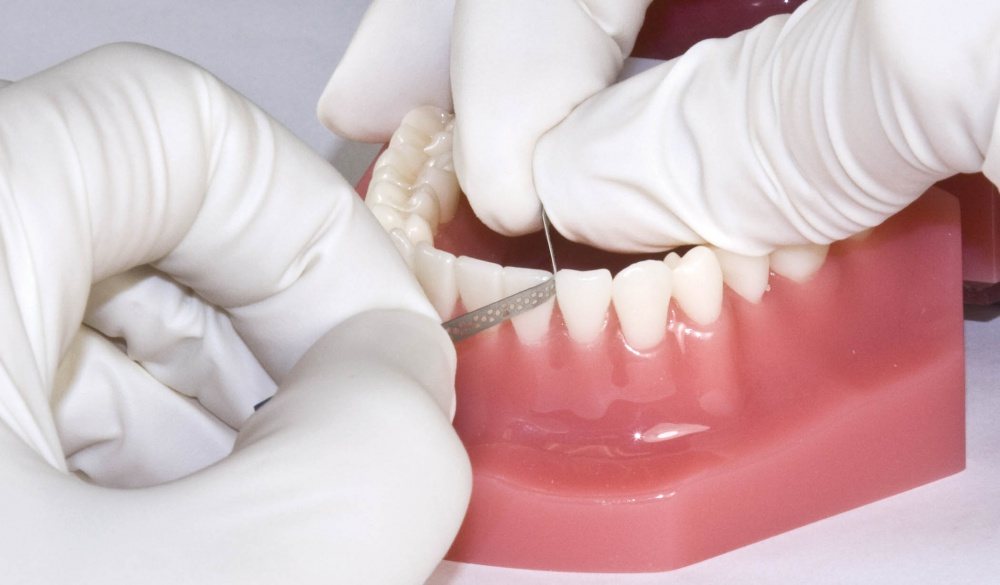 Interproximal Diamond Strips - Manual Interproximal Stripping - TOC Dental