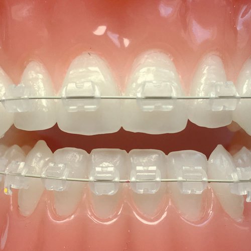 Hi-Q Coated Niti Archwire - Aesthetic wires - TOC Dental